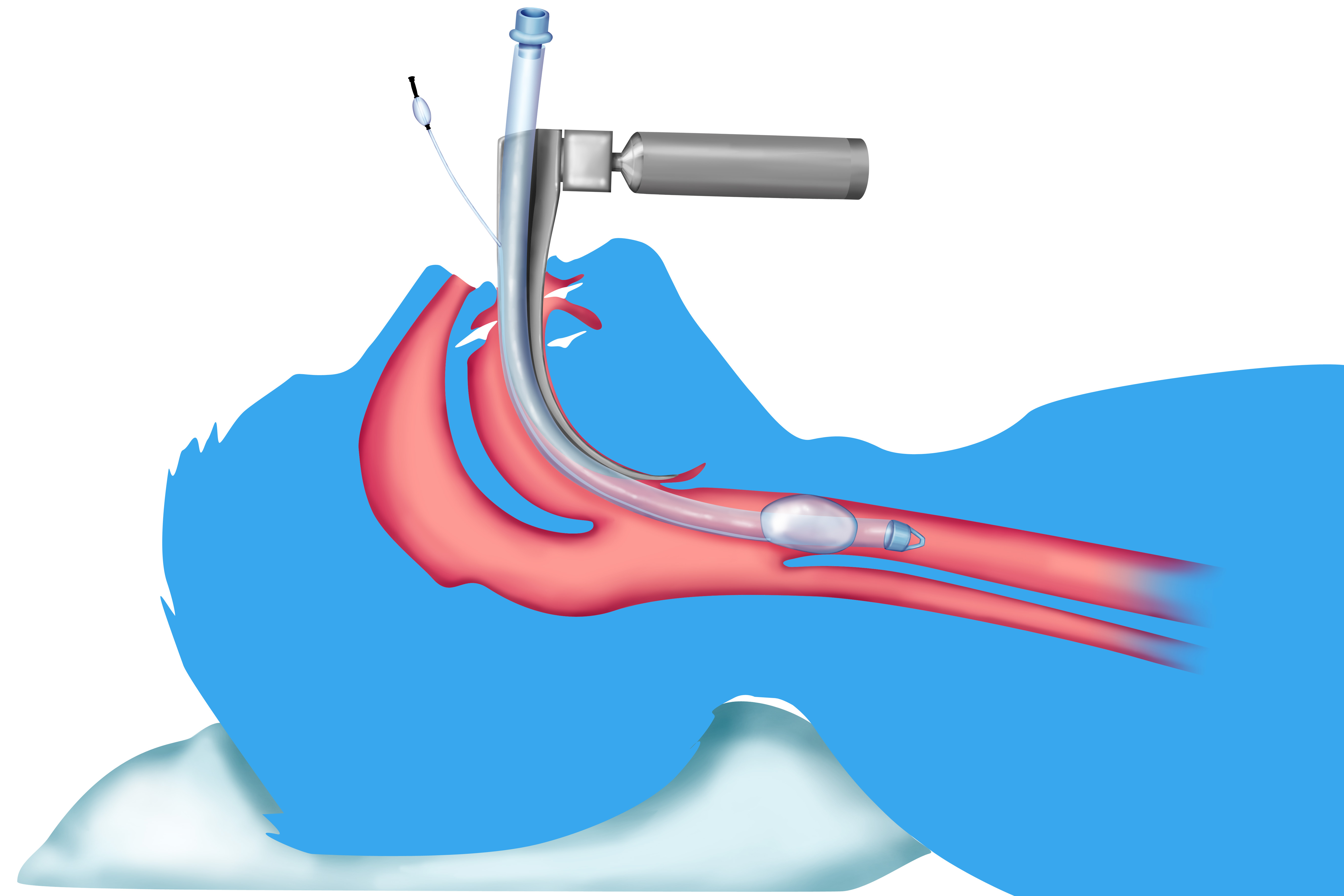 Newsela | How do ventilators work?